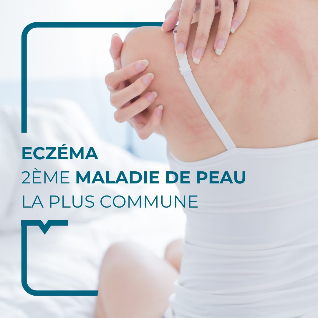 L'eczéma - Alegria Medical Centre