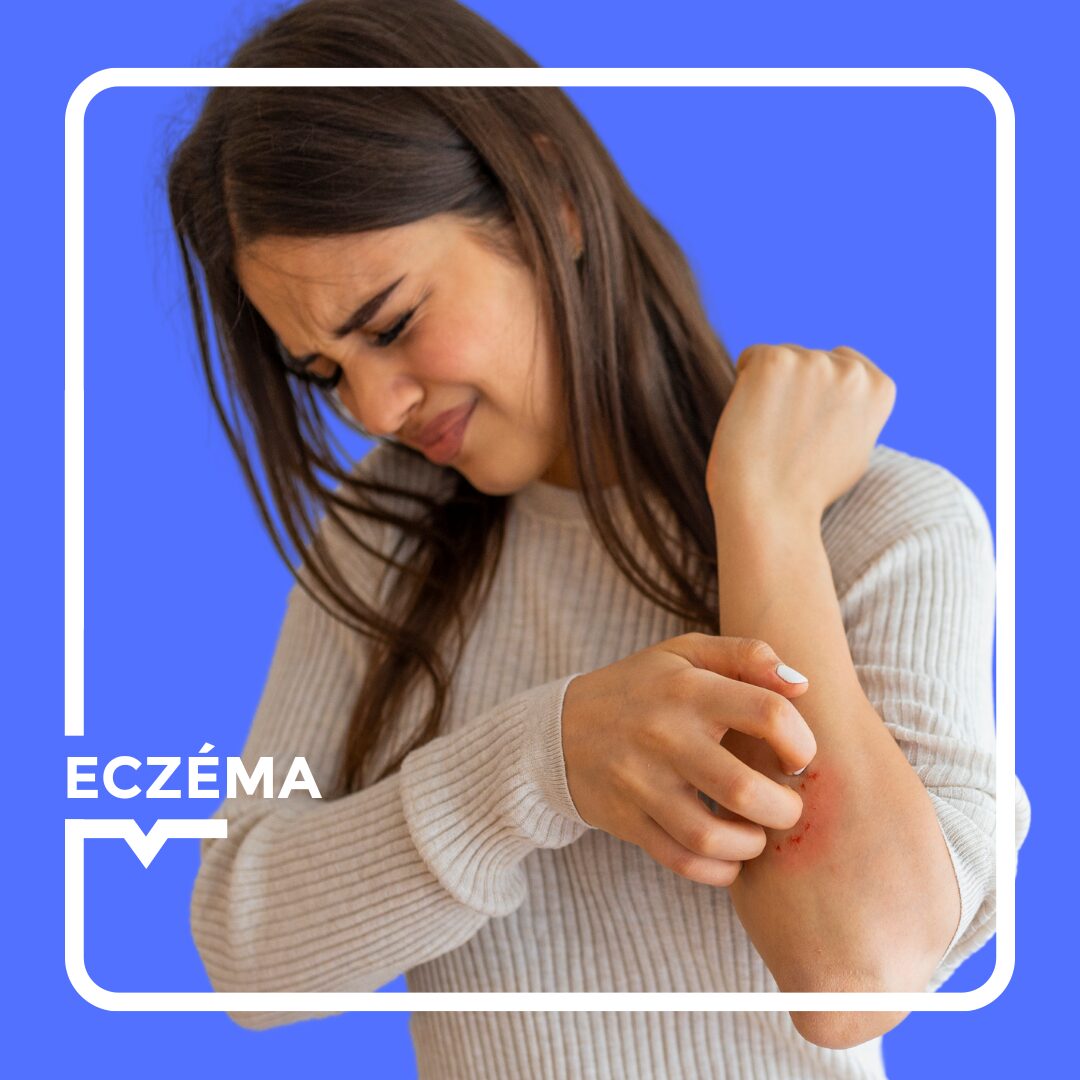 L'eczéma - Alegria Medical Centre