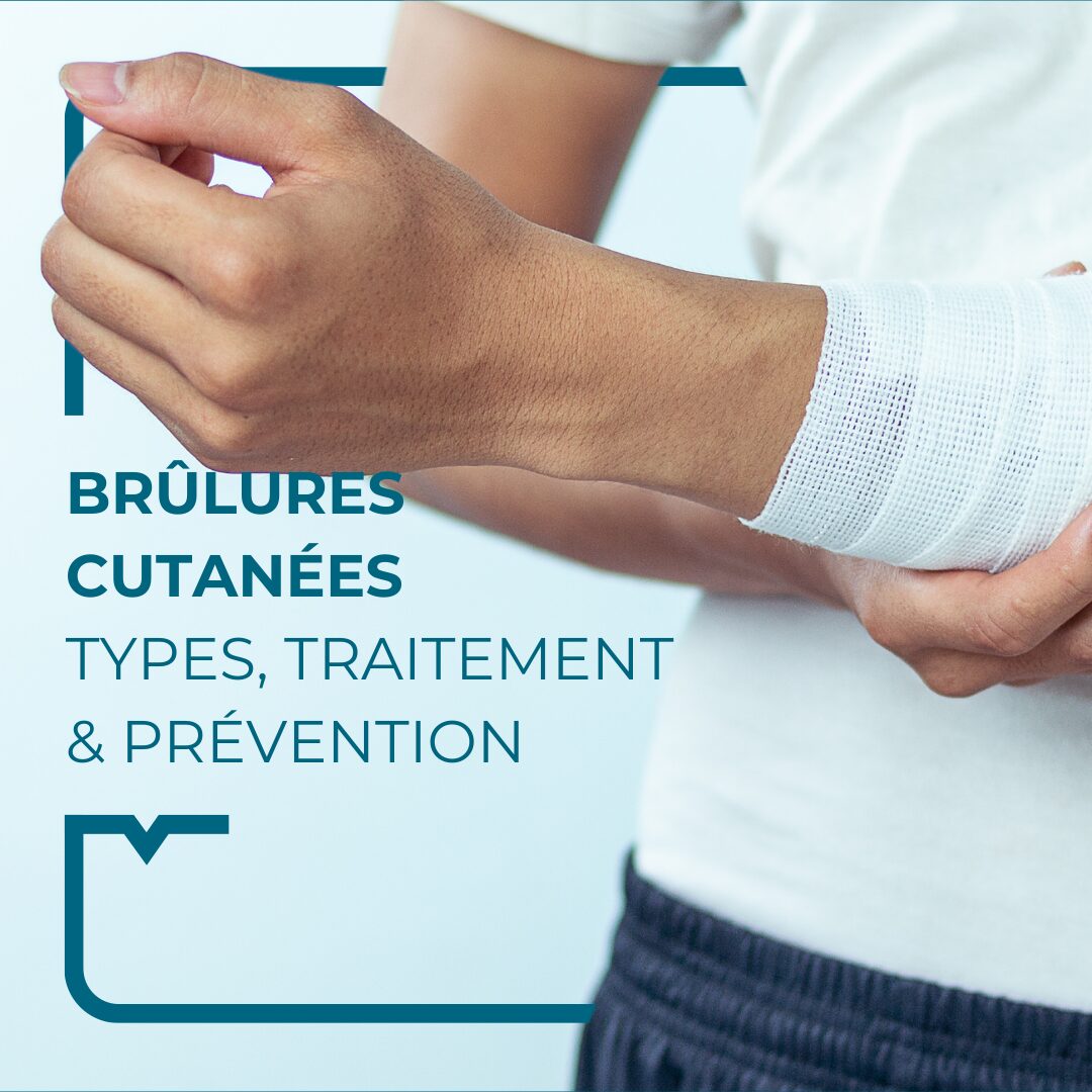Les brûlures cutanées : types, traitement et prévention - Alegria Medical Centre