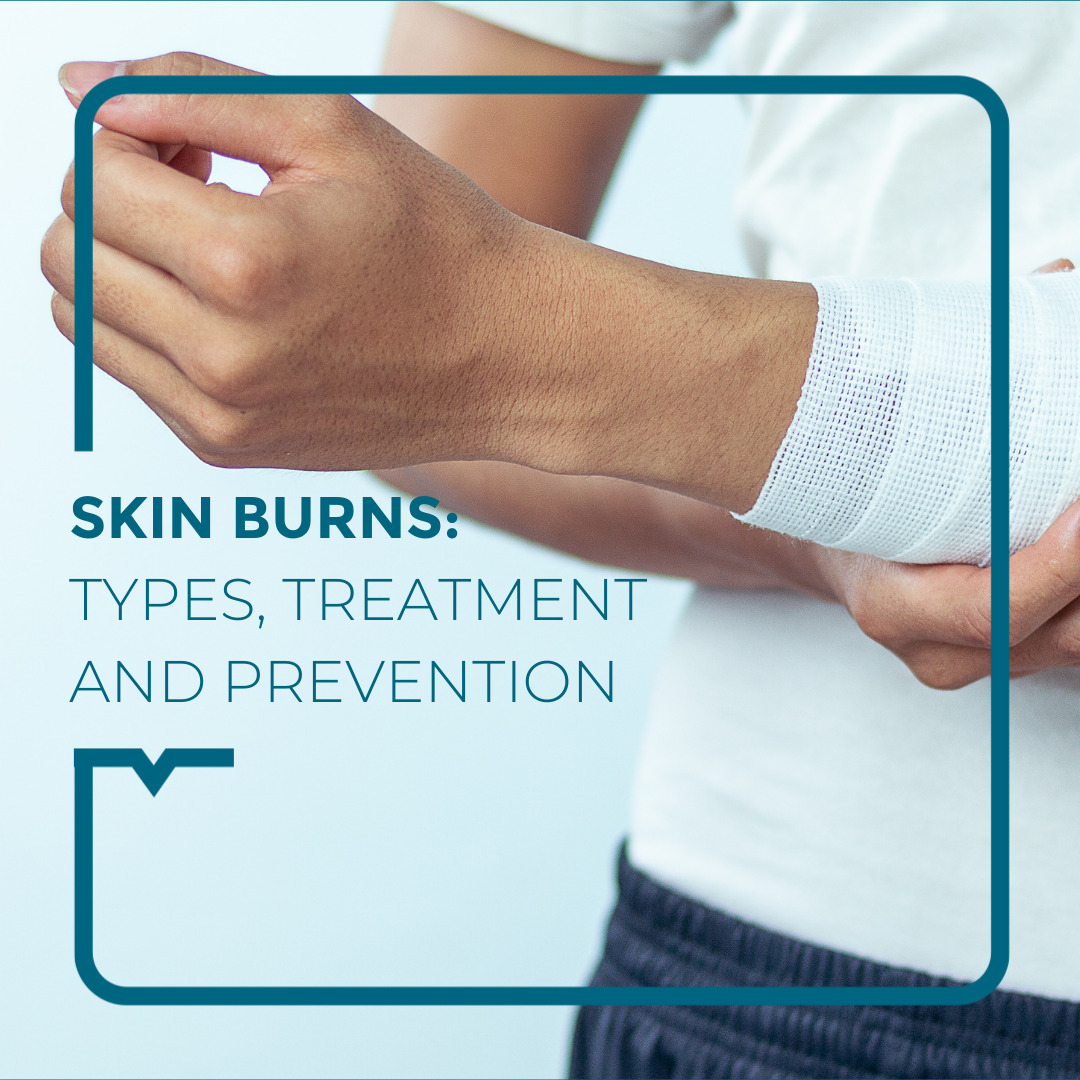 Thermal burns: type, treatment and prevention - Alegria Medical Centre