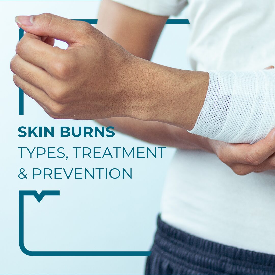 Thermal burns: type, treatment and prevention - Alegria Medical Centre