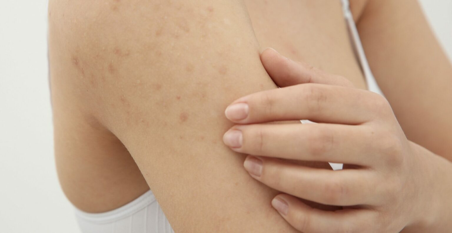 Scabies: symptoms, treatments, and prevention - Alegria Medical Centre