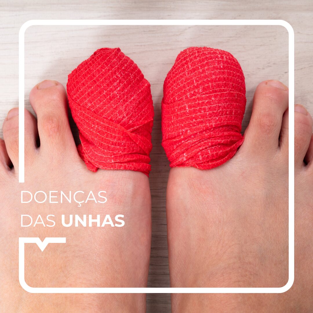 Panarício, unhas encravadas e outros problemas das unhas - Alegria ...